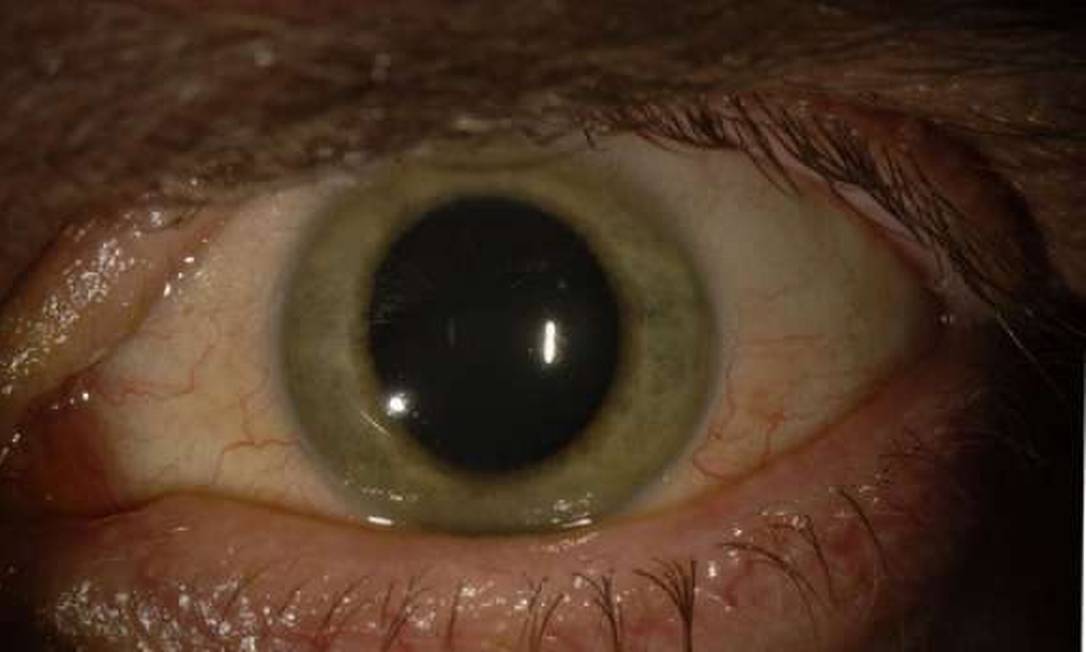 Ebola reaparece no olho e muda a cor da íris de paciente curado ...