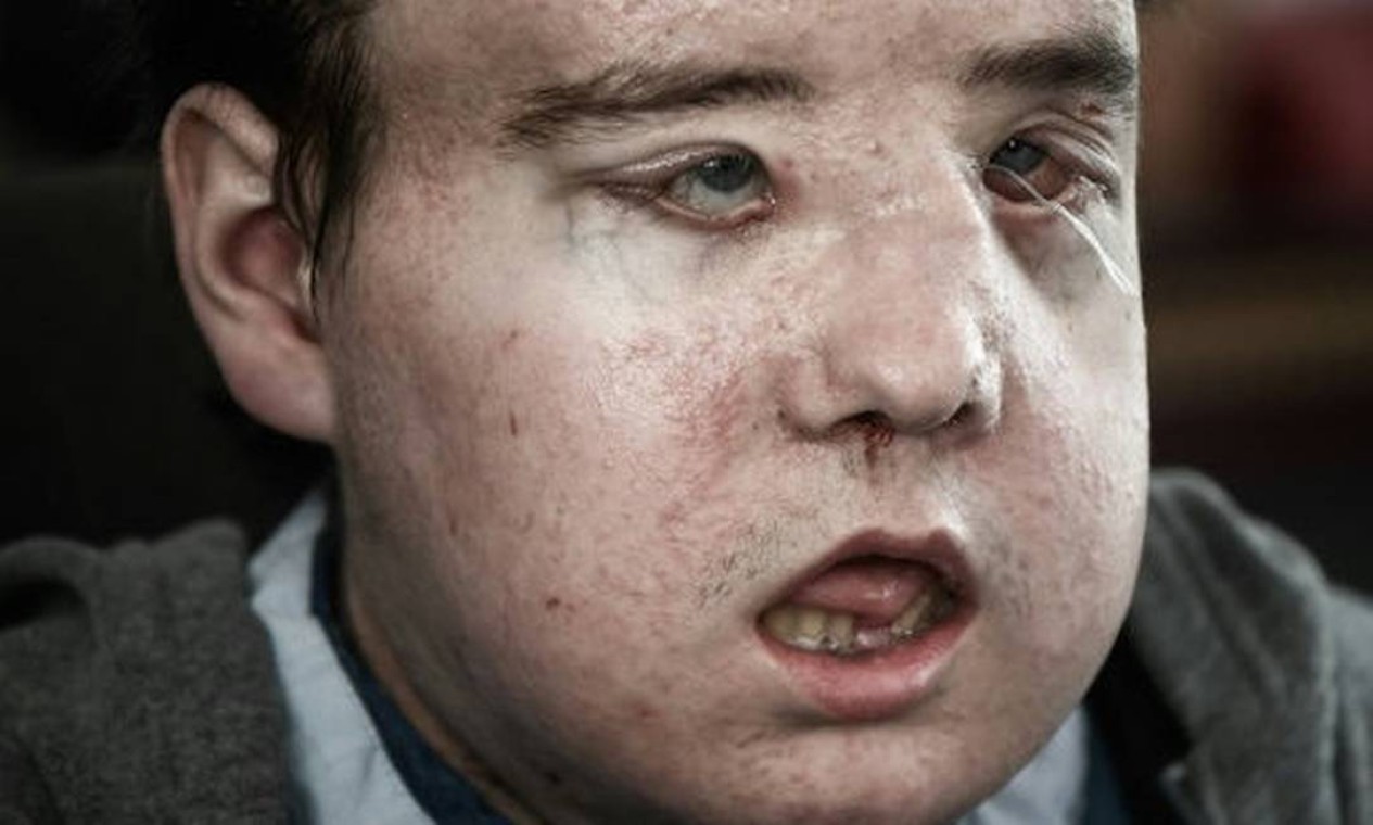 Francês é a primeira pessoa a passar por dois transplantes de rosto ...